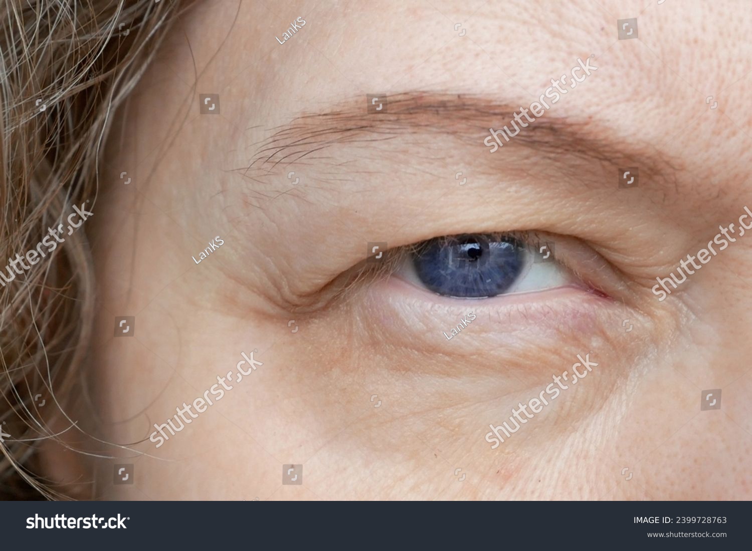 Ptosis (droopy eye lids) surgery - Maldon Eye Clinic